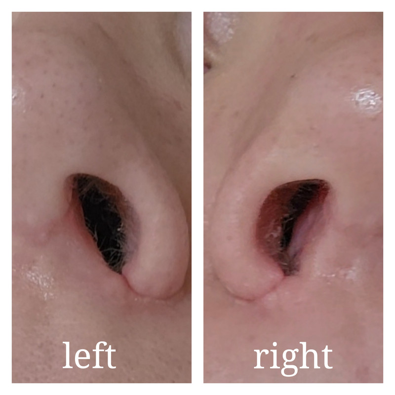 Breathing after septo-rhinoplasty revision : r/rhinoplastycommunity