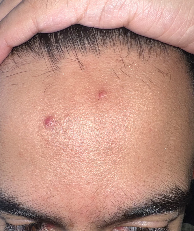 [Personal] How do I treat these pimples/spots? : r/SkincareAddiction