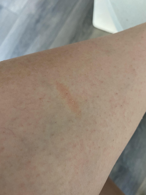 33F Weird raised red line on left leg? : r/AskDocs