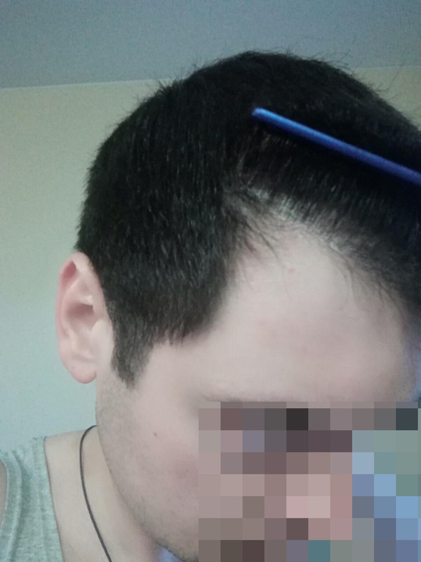 Dr. Kaan Pekiner 3003 grafts FUE (di cui 711 da barba) su NW3 vertex ...