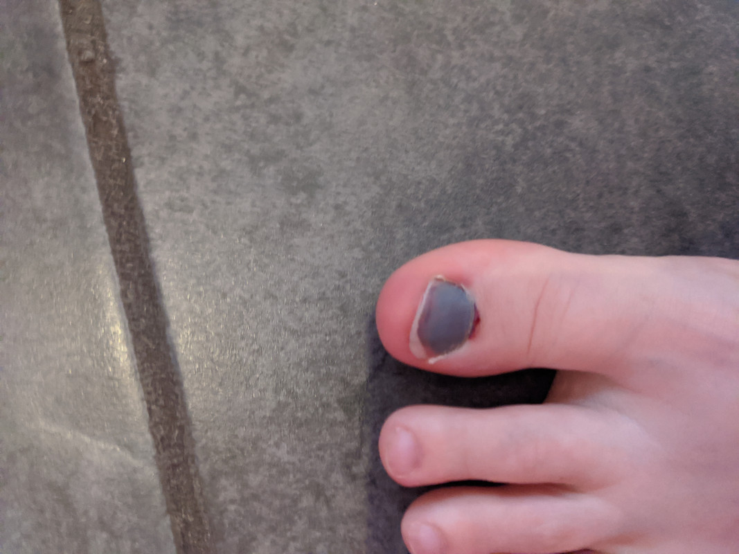 Bleeding under toenail : r/AskDocs