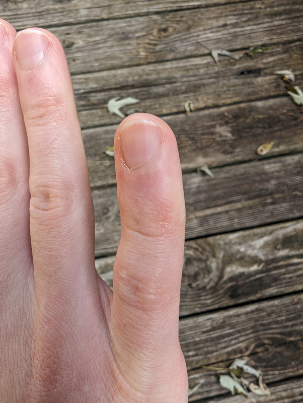 Is it normal for the skin at the tip of the fingers to look shiny like ...