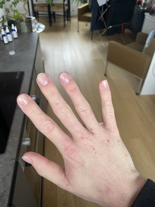 Acrylic nails for skin barrier : r/eczema