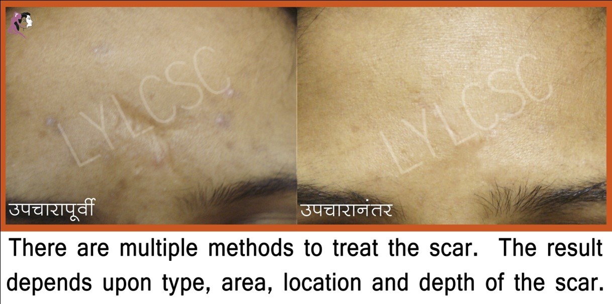 Body Scars Treatment - Look Young Laser & Cosmetic Surgery Center