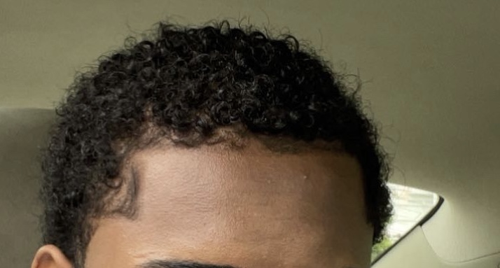 My hairline went from decent to really bad. : r/BlackHair