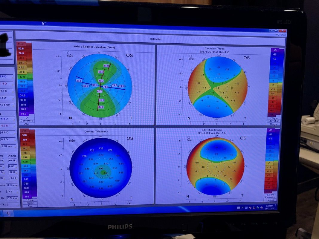 My TransPRK experience and recovery : r/lasik