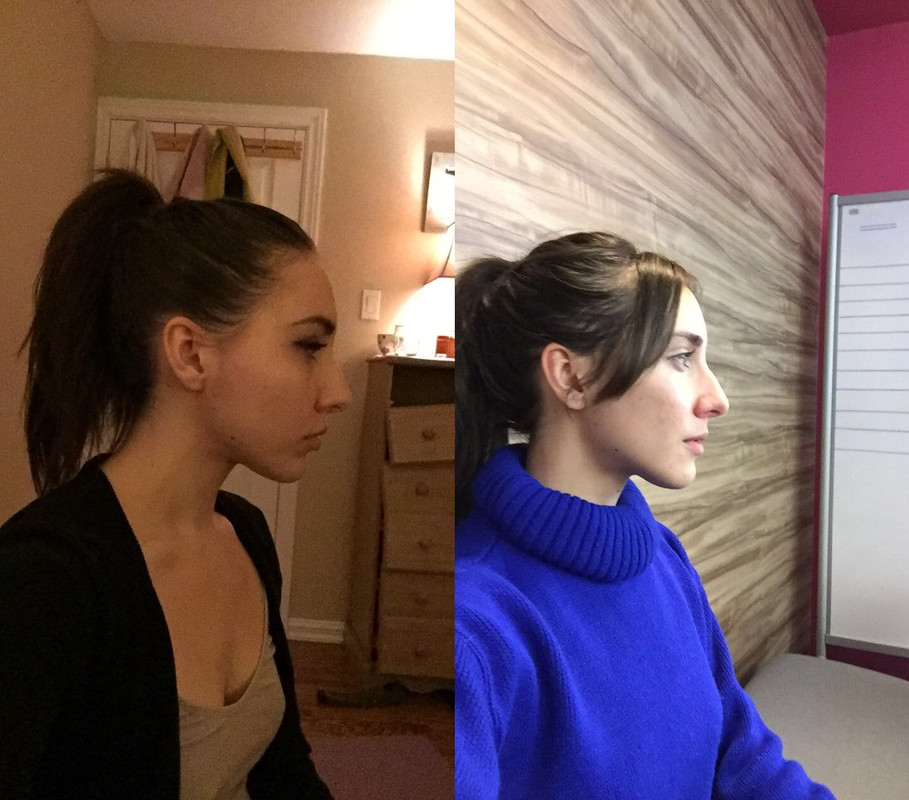 Is a narrow palate a failo? : r/Vindicta