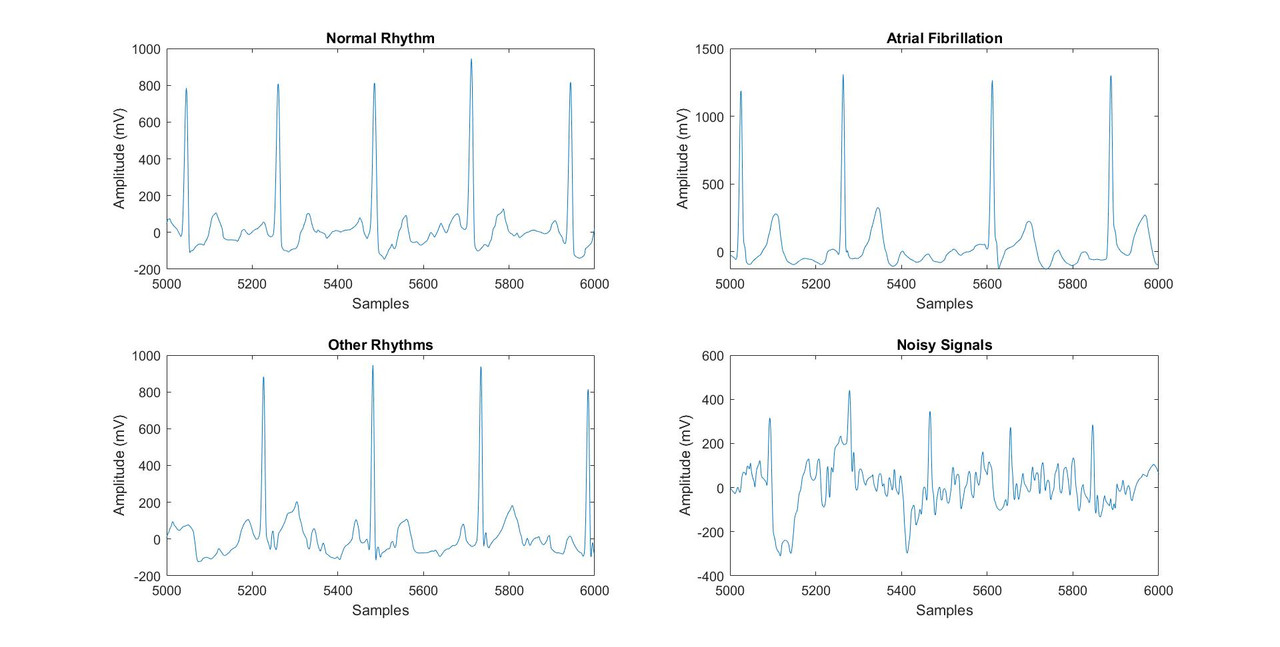 Github Arkanivasarkar Ecg Anomaly Detection Using Deep Learning