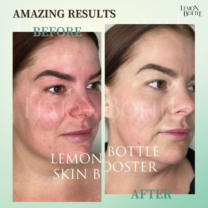 Lemon Bottle Skin Booster Before and After With Photos - Maylips