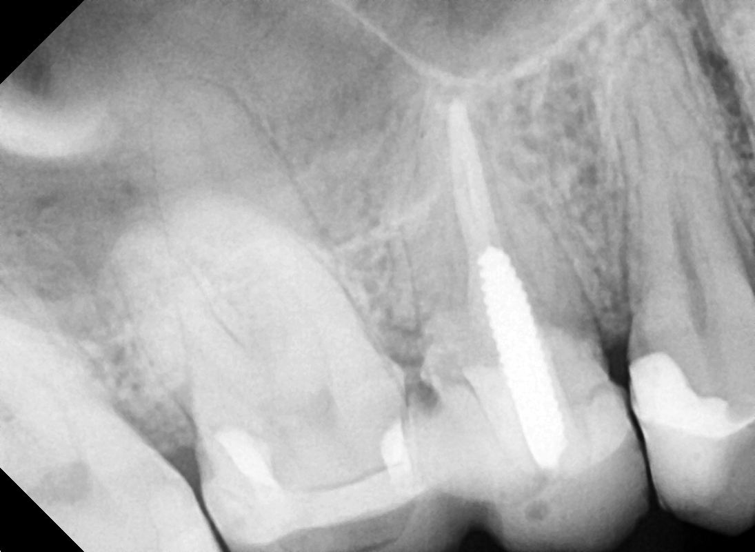2 weeks of pain from temporary crowns, should I still get the permanent ...
