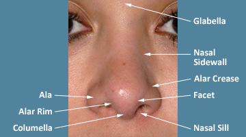 Phenotypes without a nasal sill?