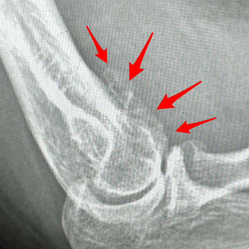 Anyone had elbow arthroscopy? : r/ehlersdanlos