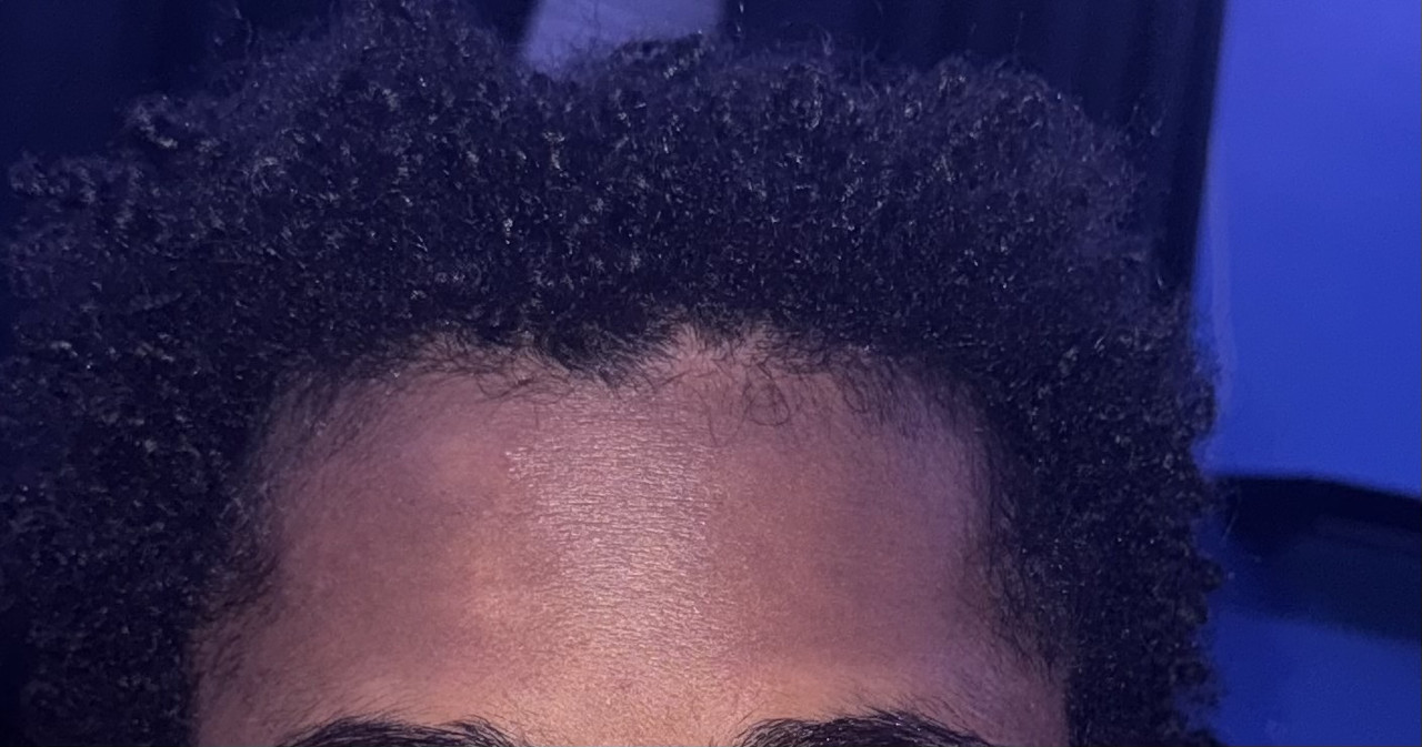 My hairline went from decent to really bad. : r/Hairloss