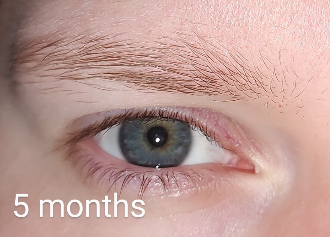 Eyebrows filling in on oral minoxidil : r/FemaleHairLoss