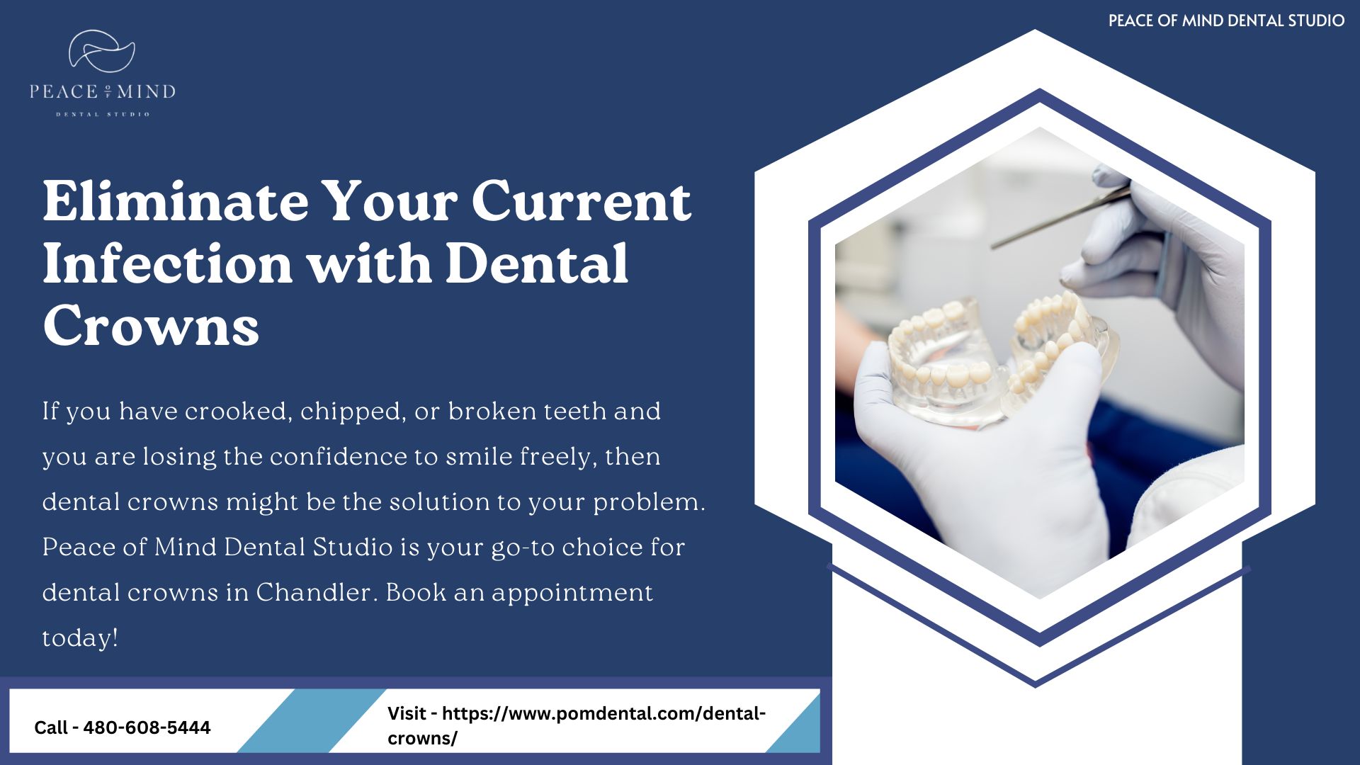 Eliminate Your Current Infection with Dental Crowns (1) — Postimages