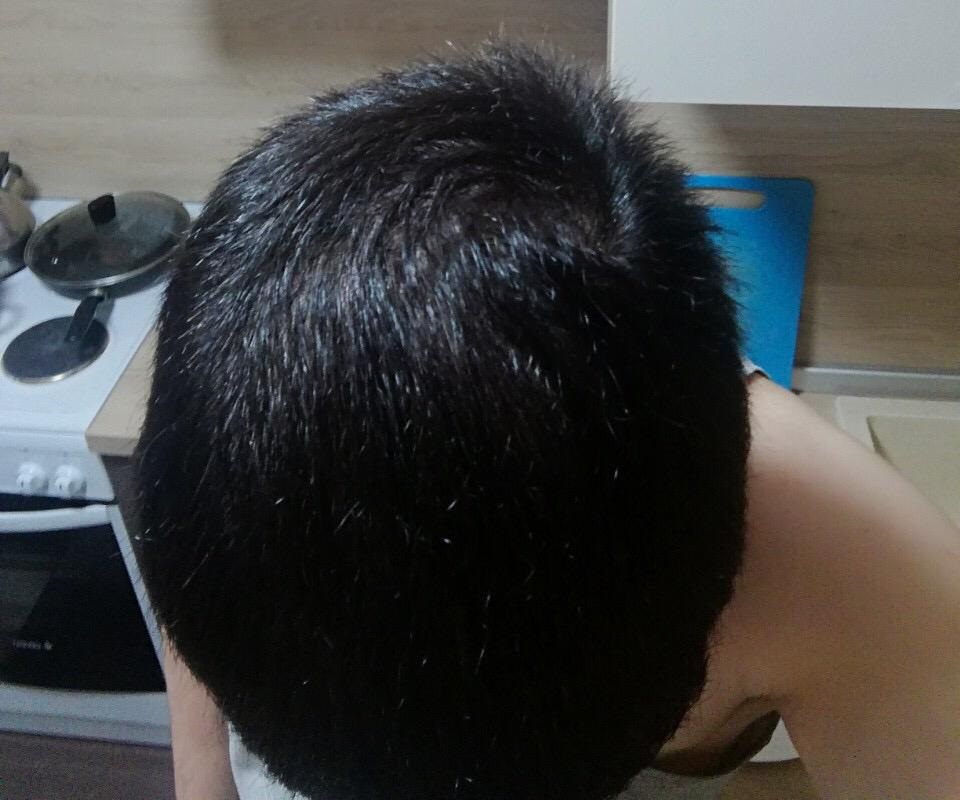 Dr. Kaan Pekiner 3003 grafts FUE (di cui 711 da barba) su NW3 vertex ...