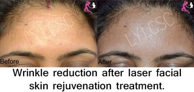 Laser Wrinkles Reduction - Look Young Laser & Cosmetic Surgery Center