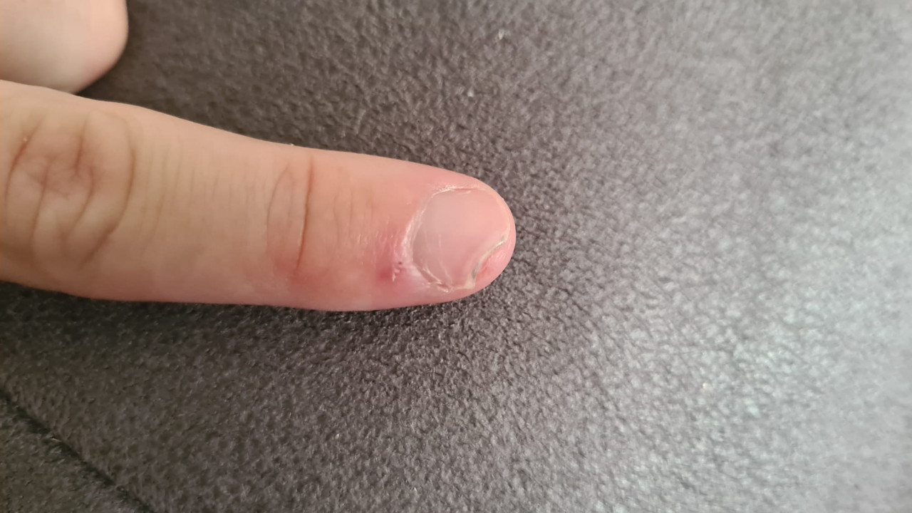 31M That accidentally cut half of my fingernail off; Will this grow ...