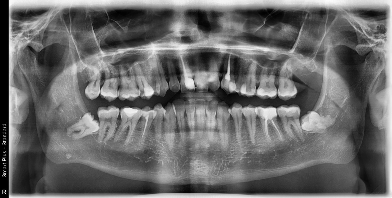Unexplained pain /third molars or TMJ : r/askdentists