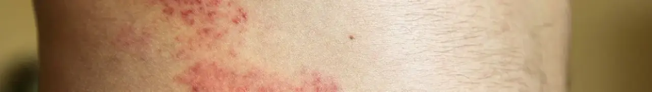 Should I See a Dermatologist for Shingles? | CA Dermatology