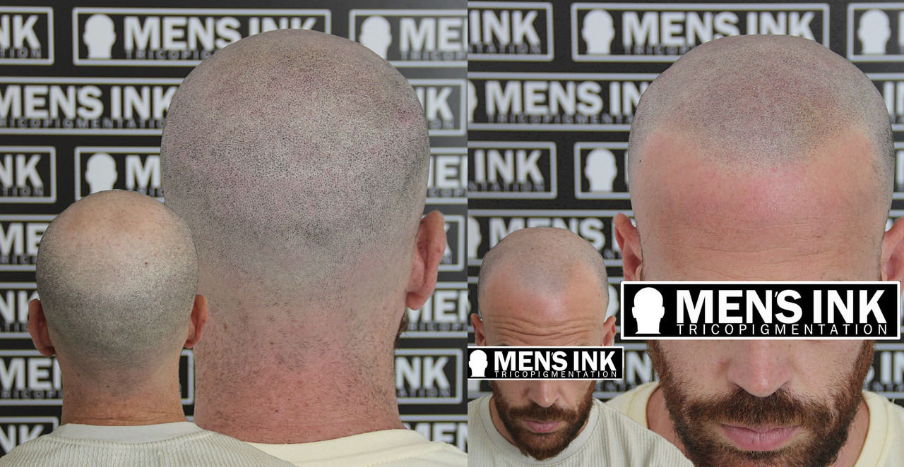 Men's Ink - 02/09/23 Tricopigmentation effet cheveux rasé ...