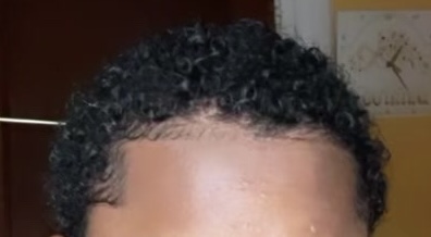 My hairline went from decent to really bad. : r/Hairloss