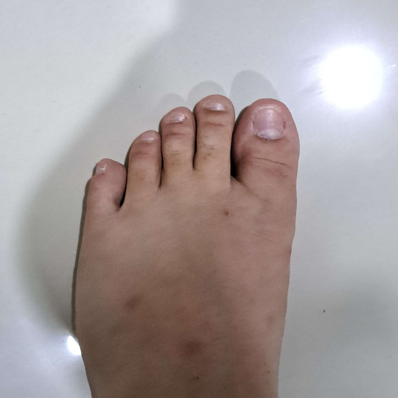 What the hell is wrong with my pinky toe? It's like curved in and ...