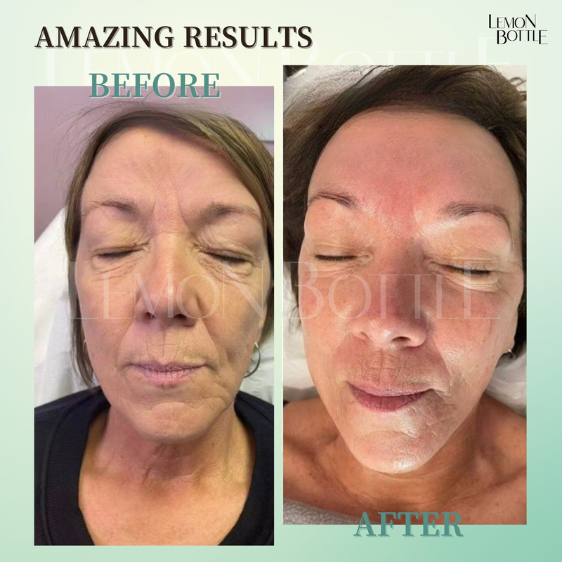 Lemon Bottle Skin Booster Before and After With Photos - Maylips