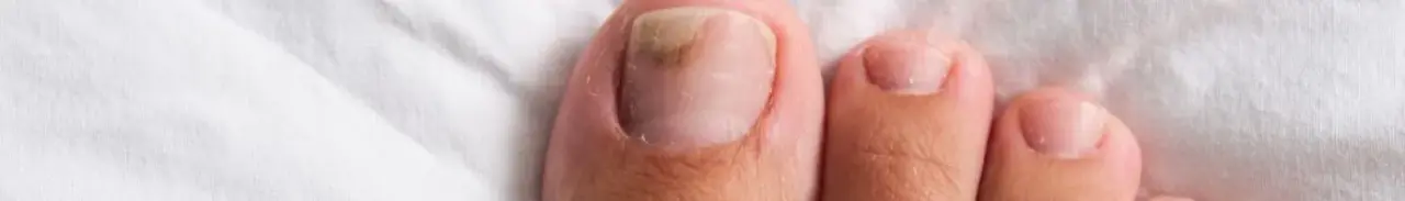 Should I See a Dermatologist for Toenail Fungus Treatment?