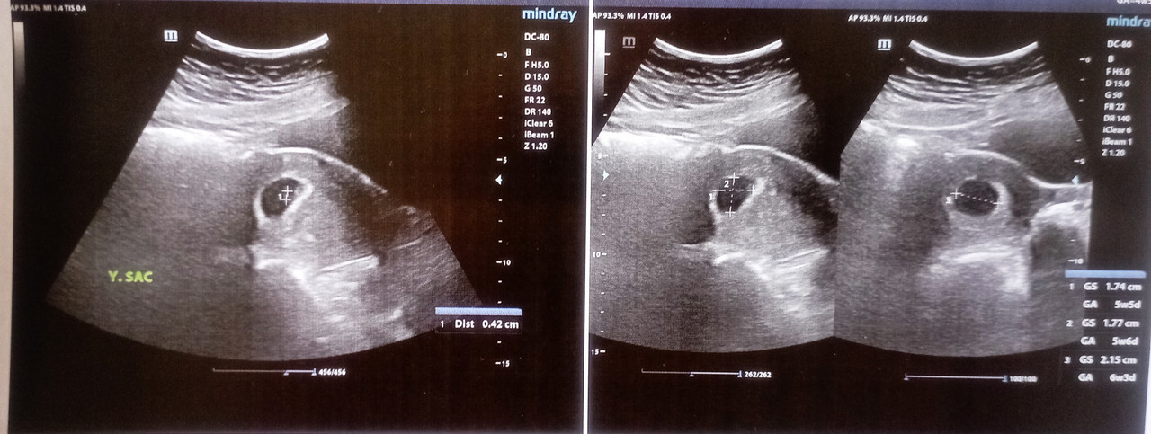 7 weeks USG lagging behind by 1 week : r/IVF