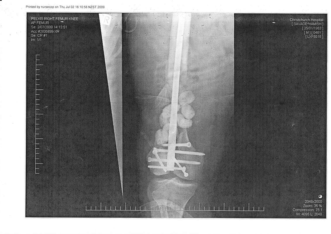 metal bones 0010 — Postimages