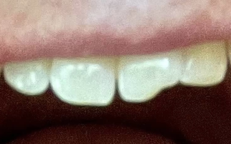 Cost to fix minor chip in front tooth? : r/askdentists