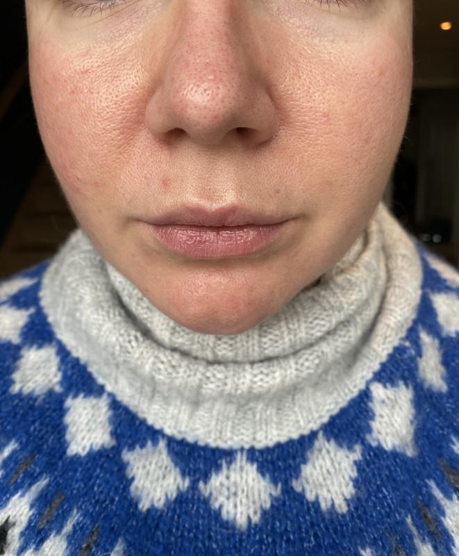 Big pores and oily skin, with a dash of texture/acne now : r/30PlusSkinCare