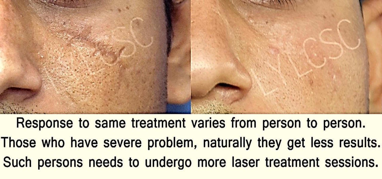 Body Scars Treatment – Look Young Laser & Cosmetic Surgery Center