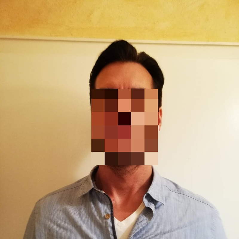 Dr. Kaan Pekiner 2001 grafts FUE dense pack Bellicapelli Forum