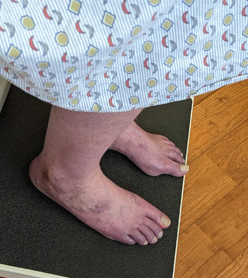 Why are my [28F] feet so hideous? It's been slowly getting worse over ...