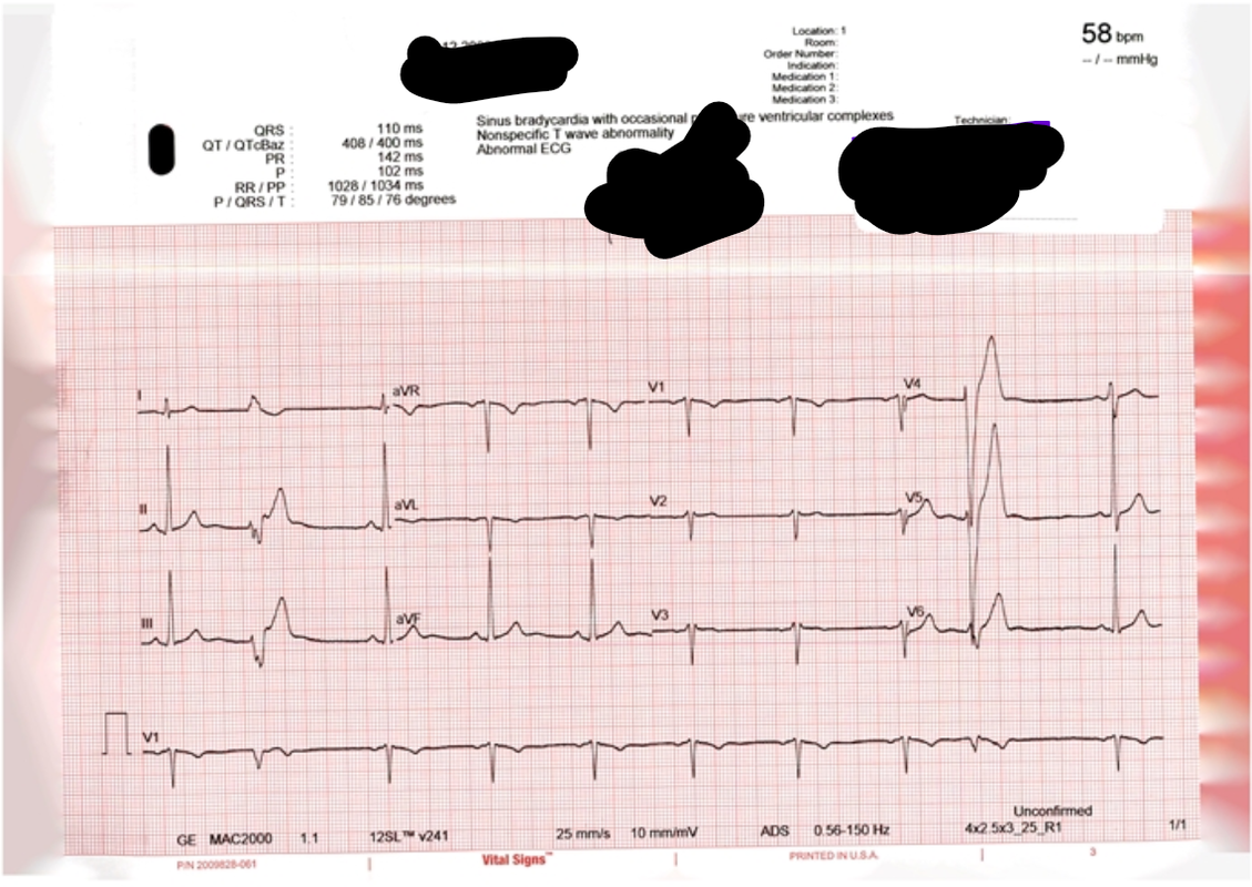 Asymptomatic run of 6 beats NSVT. My doctor wants me to get a nuclear ...