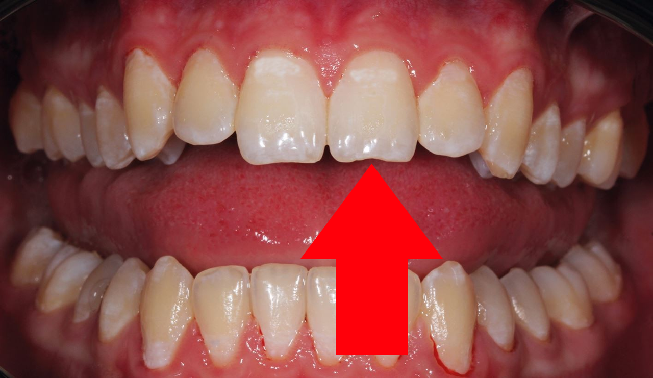Can this enamel decay be reversed? : r/Teethcare