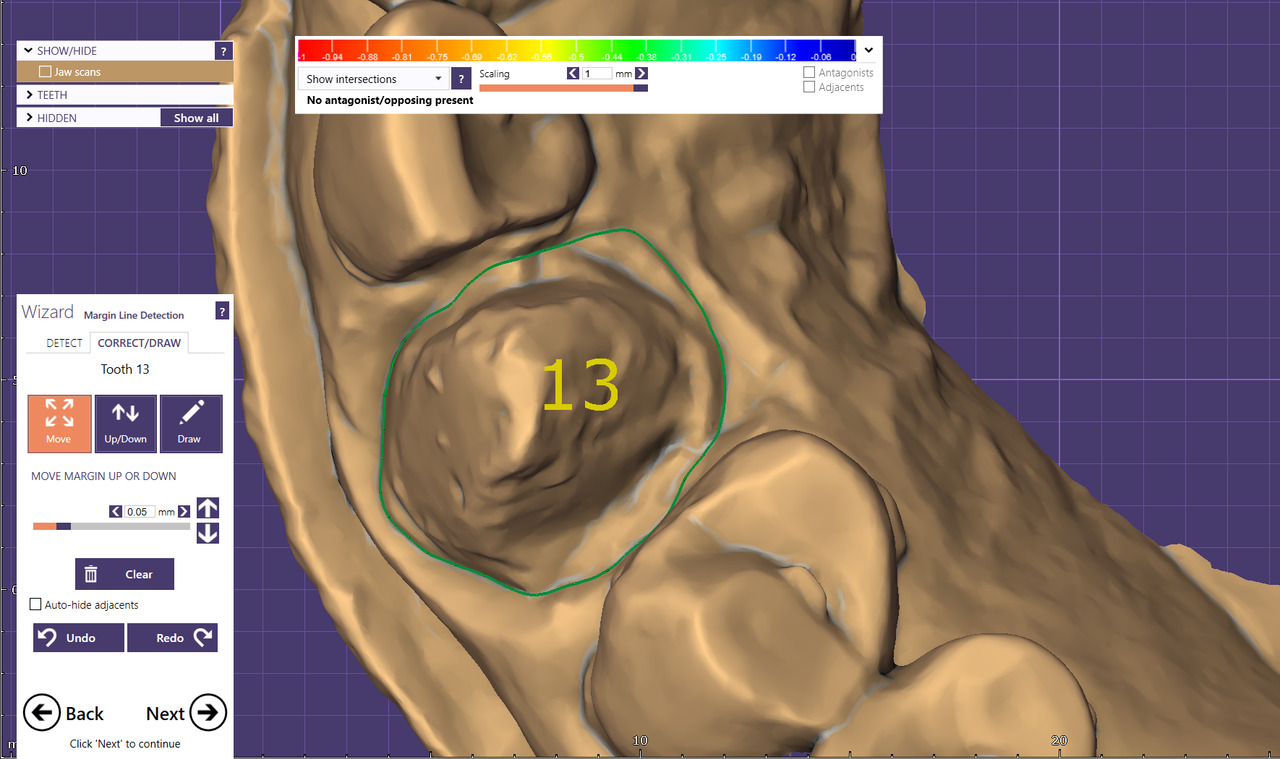 Detect a bad margin lines with exocad | Dental Lab Network