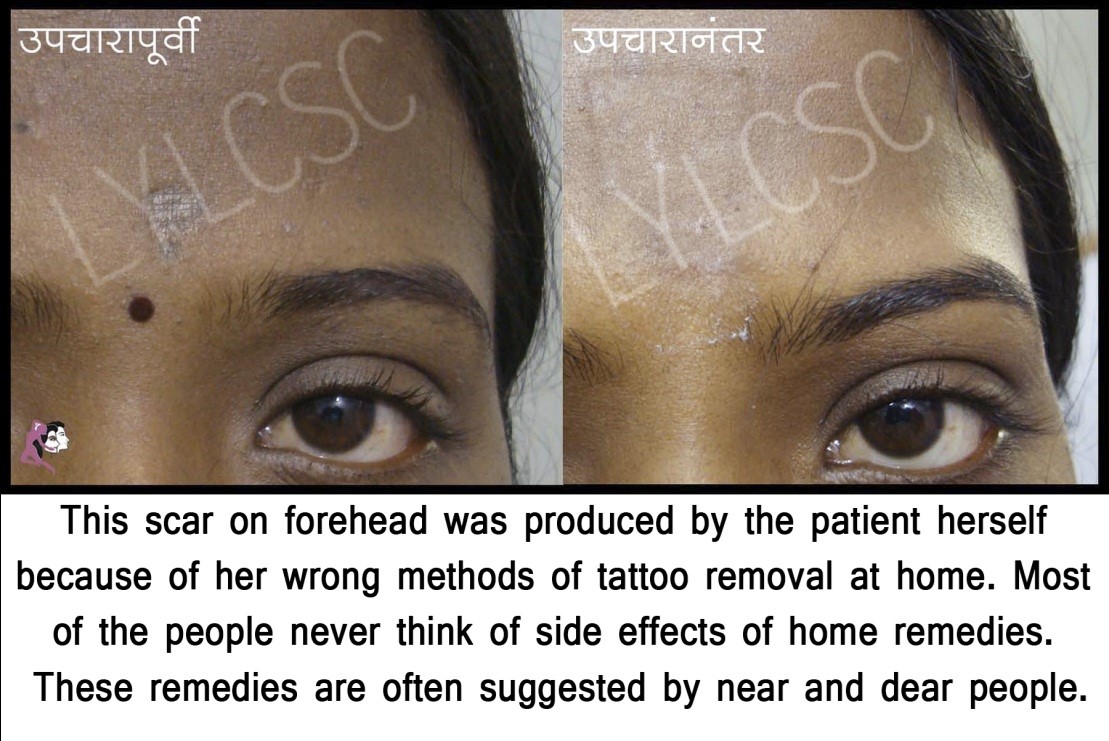 Body Scars Treatment – Look Young Laser & Cosmetic Surgery Center