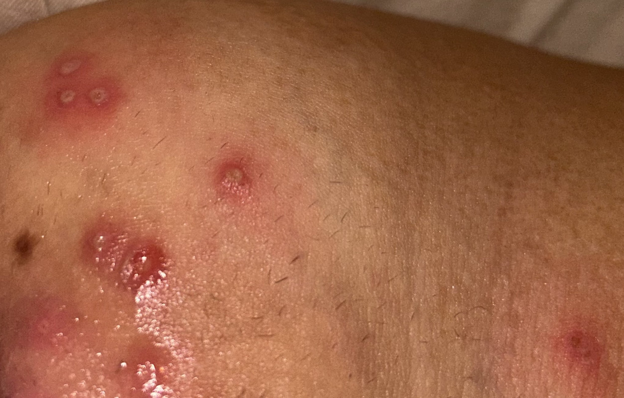 WARNING GRAPHIC blisters yeast infection r Healthyhooha