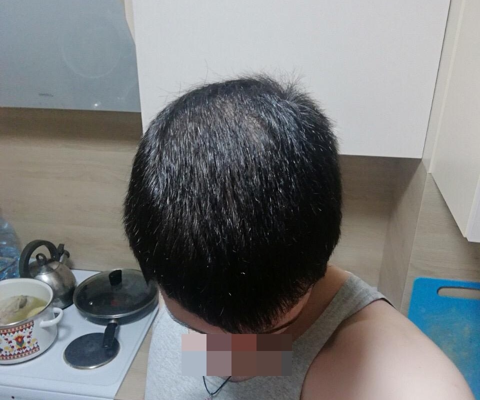 Dr. Kaan Pekiner 3003 grafts FUE (de los cuales 711 de la barba) en NW3 ...