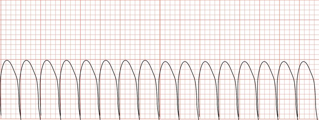 A client is attached to a cardiac monitor, and the nurse not | Quizlet