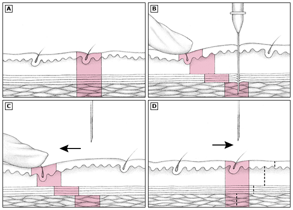 Can I use 27g 1/2" needles for subq, or must it be 5/8"? : r/TransDIY