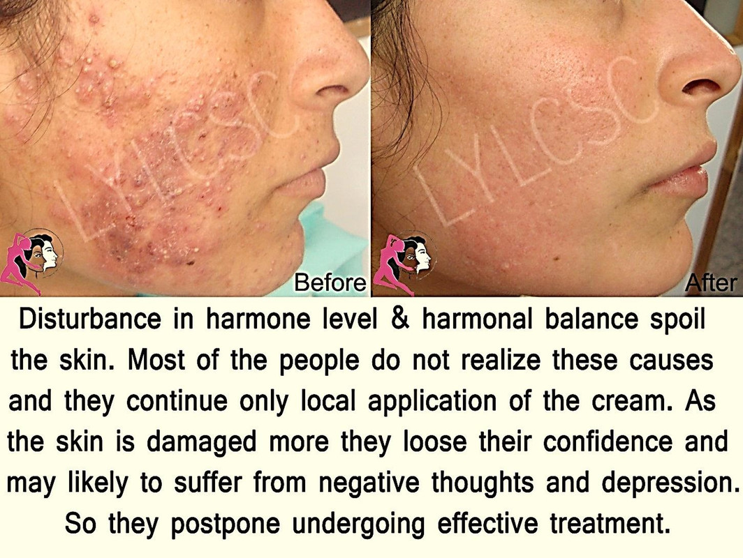 Laser Acne Treatment - Look Young Laser & Cosmetic Surgery Center