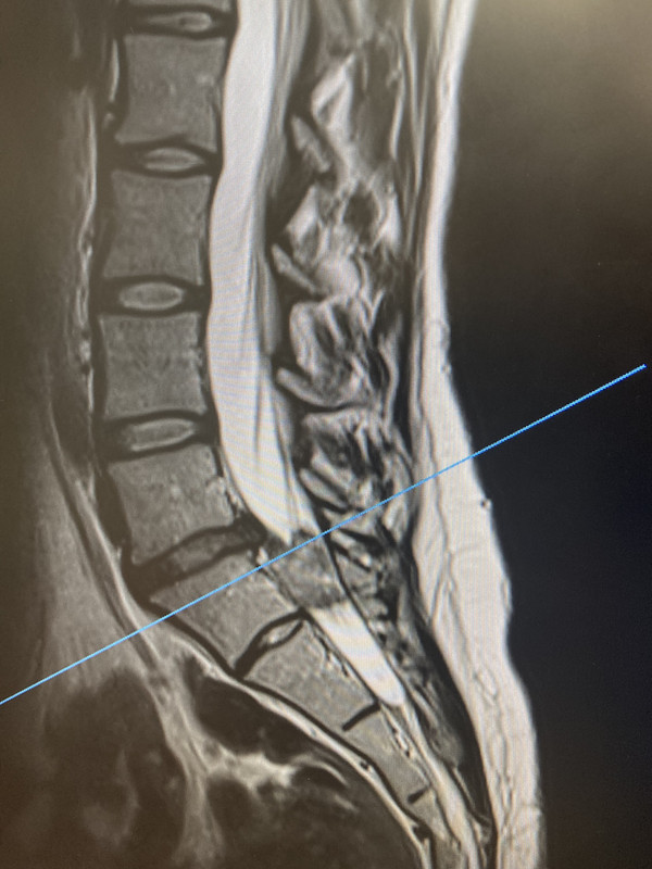 Anyone recovered from a 13mm disc bulge without surgery? More info in ...