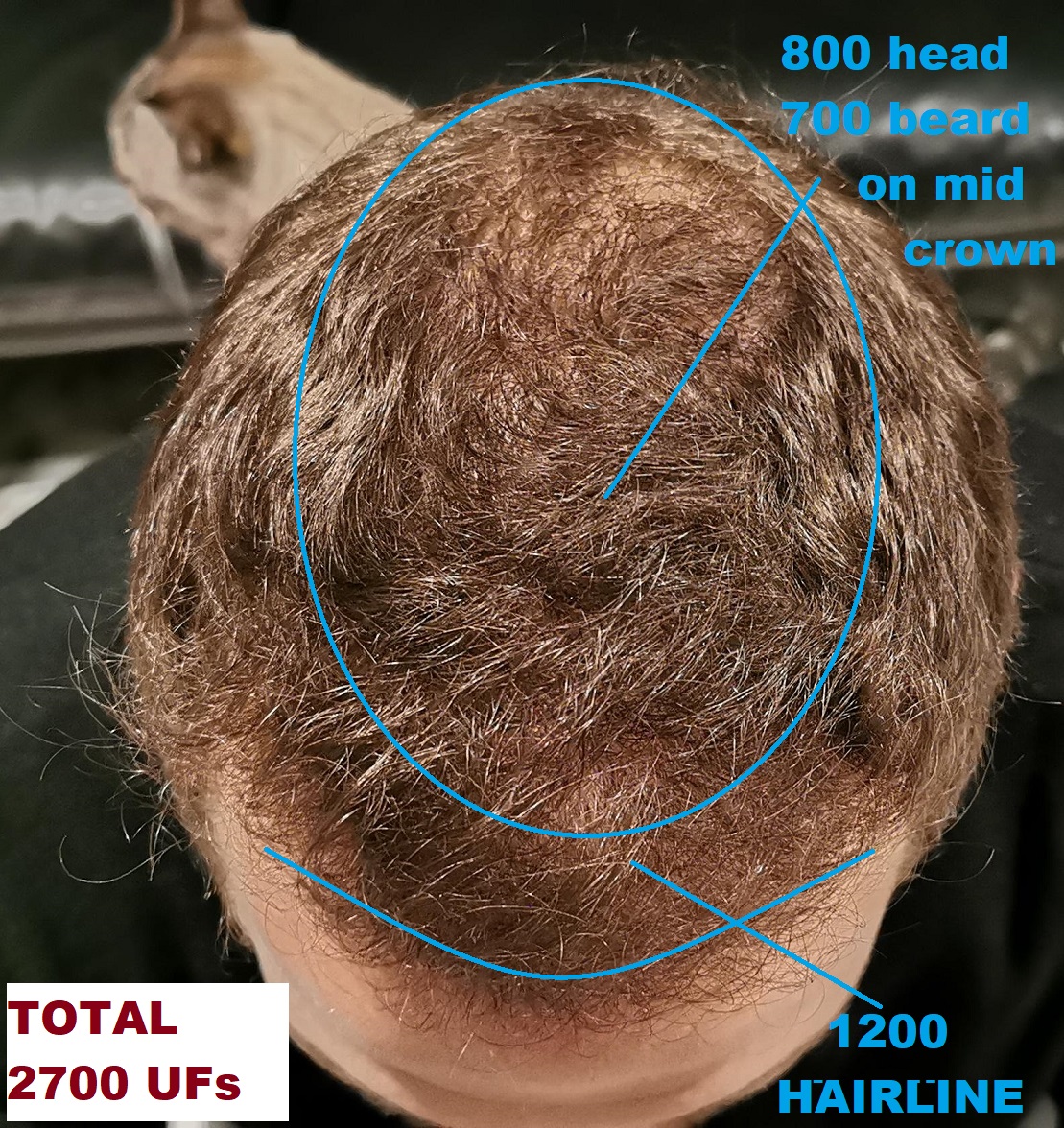 1200 head to hairline 800 head 700 beard mid crown total 2000 head 700 beard — Postimages