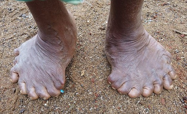 Biggest big toe - 24hourcampfire