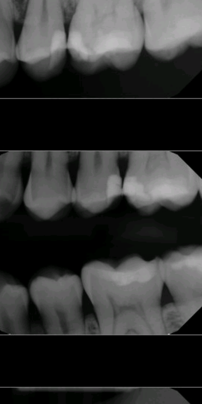 I did 2 class 4 comp restorations on tooth #11 #21 (Miso-insico-lingual ...