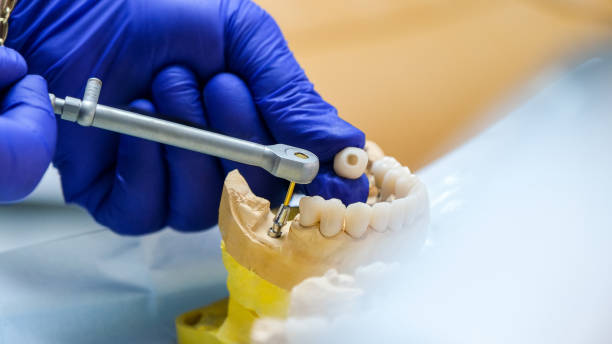 Titanium Dental Implants Market Forecasted to Grow at an 11.0% CAGR by ...